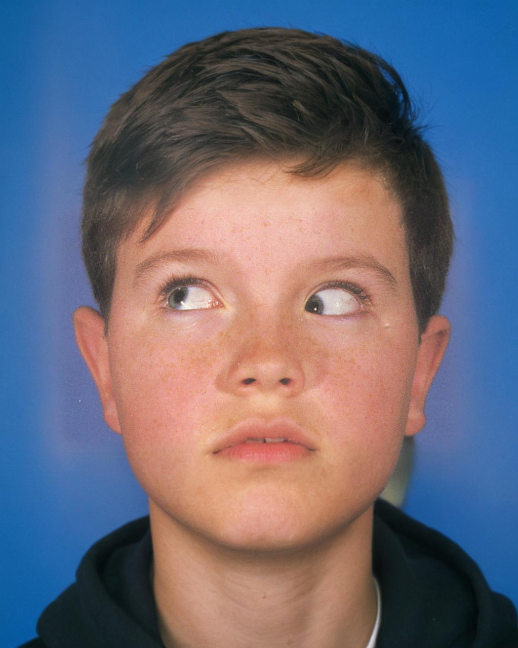 Misc Strabismus | Ghostdogg1ca